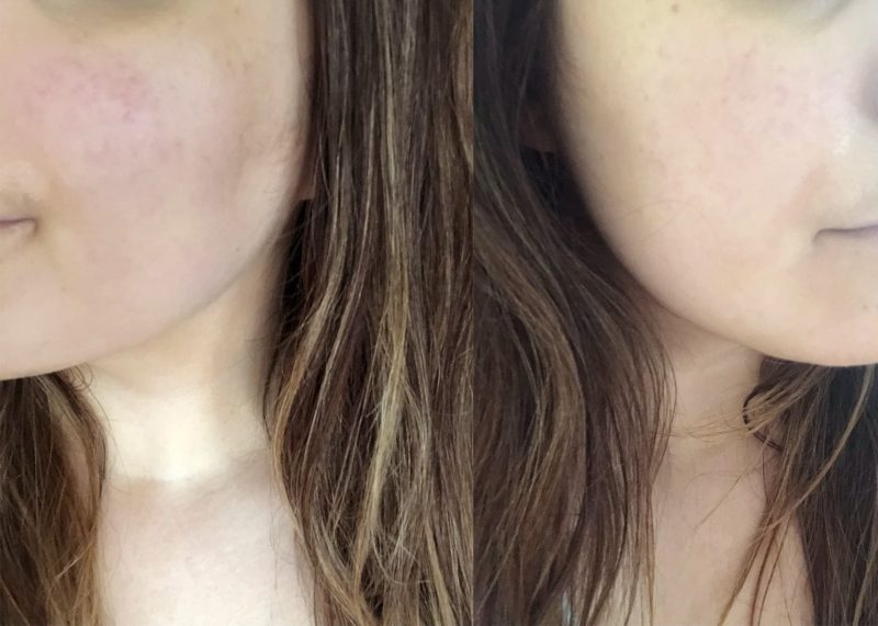 The One Thing I Eliminated From My Diet To Clear My Cystic Acne | Mash Elle